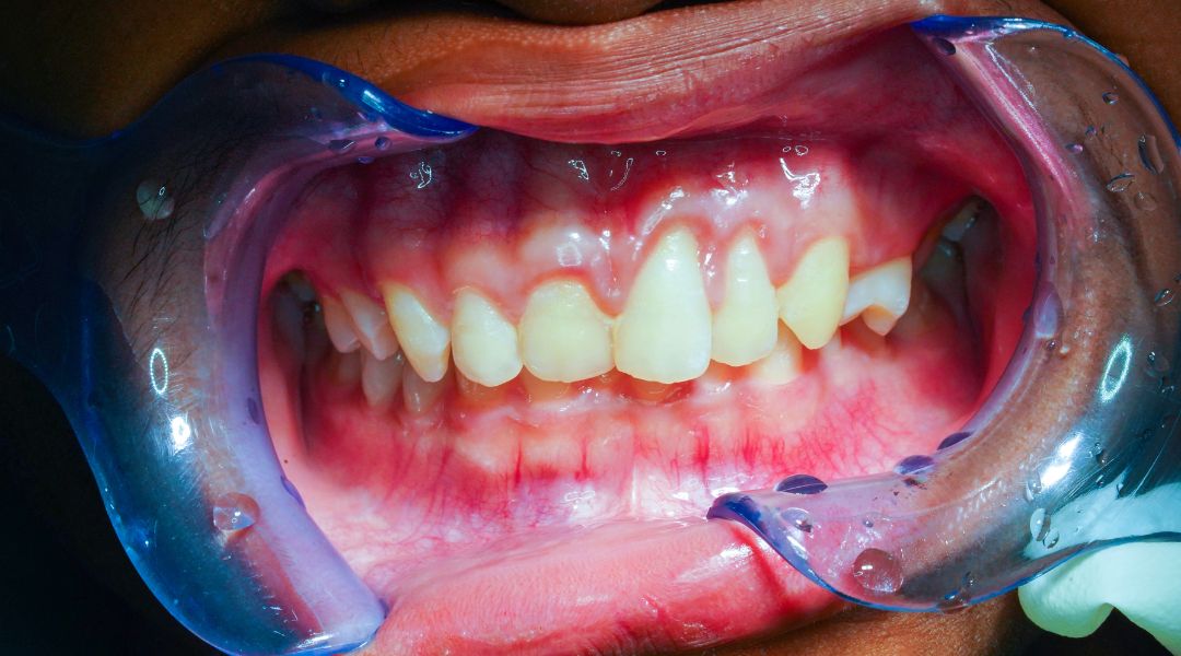 Receding Gum Line? Here is Why! | Four Rivers Periodontics