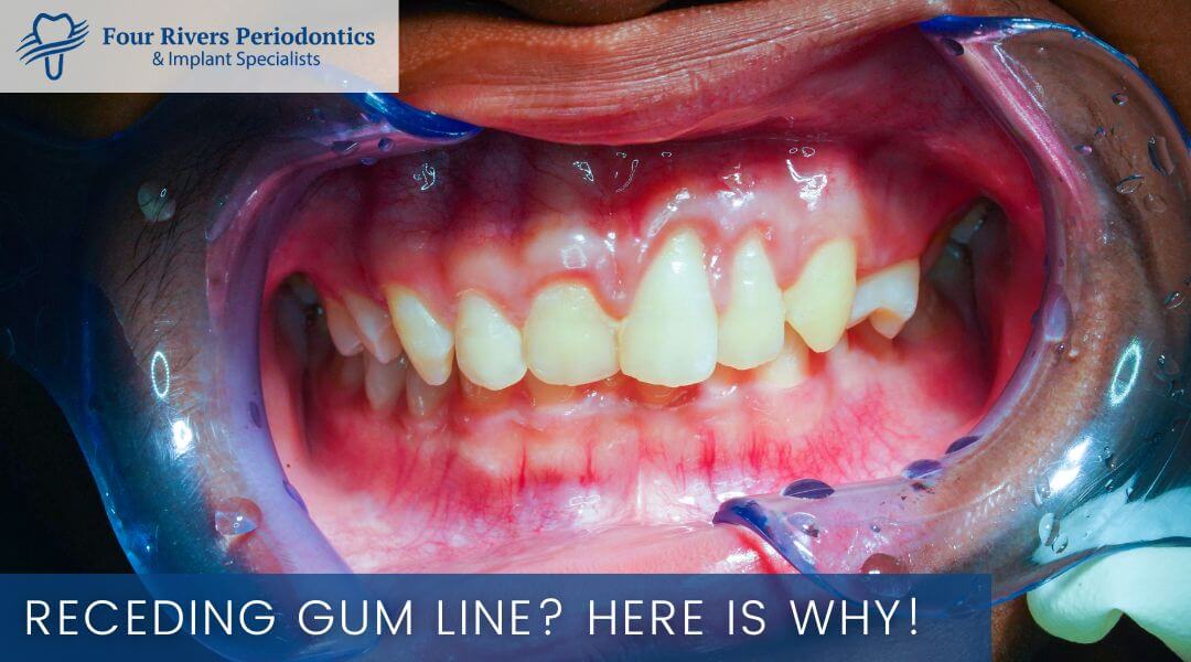 Receding Gum Line? Here is Why! | Four Rivers Periodontics
